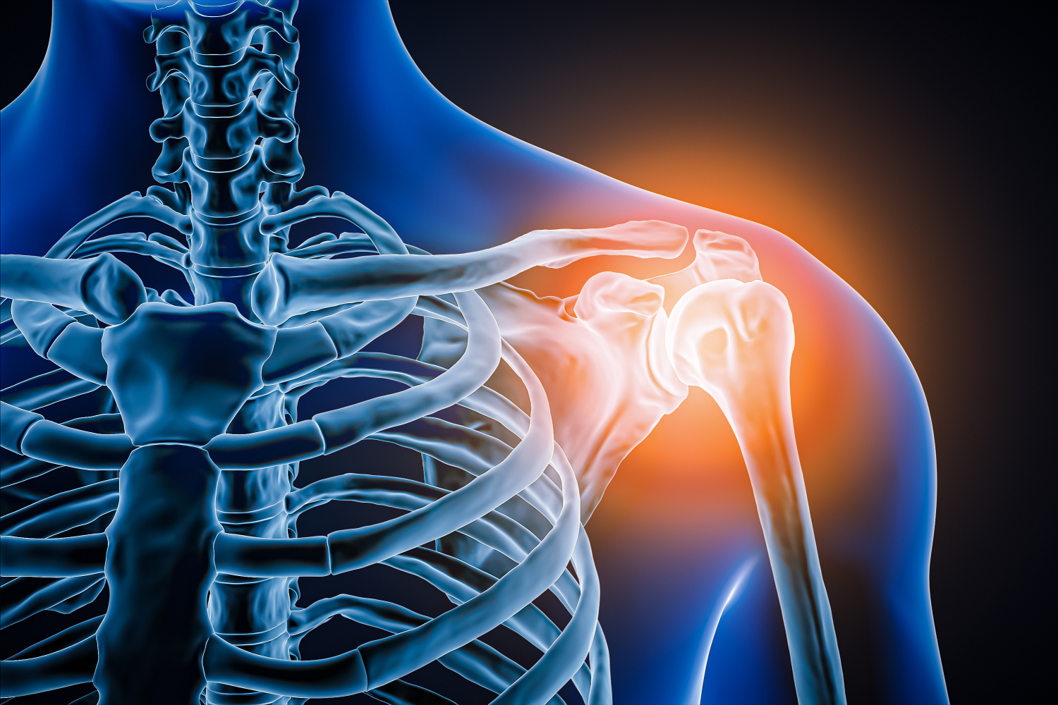 Reverse Shoulder Replacement - Yellowstone Sports Medicine