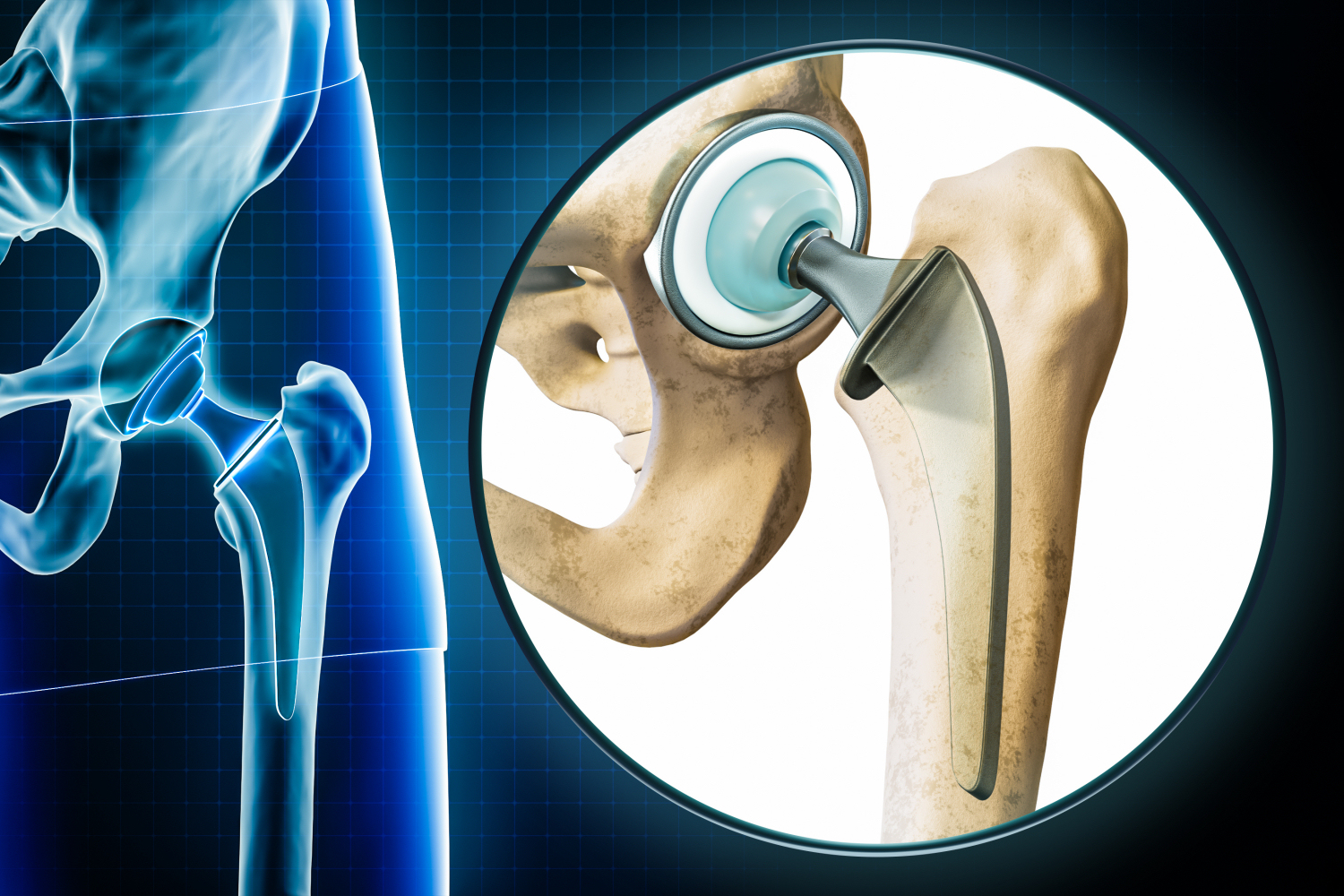 Total Joint Replacement - Yellowstone Sports Medicine | Cody | Powell ...